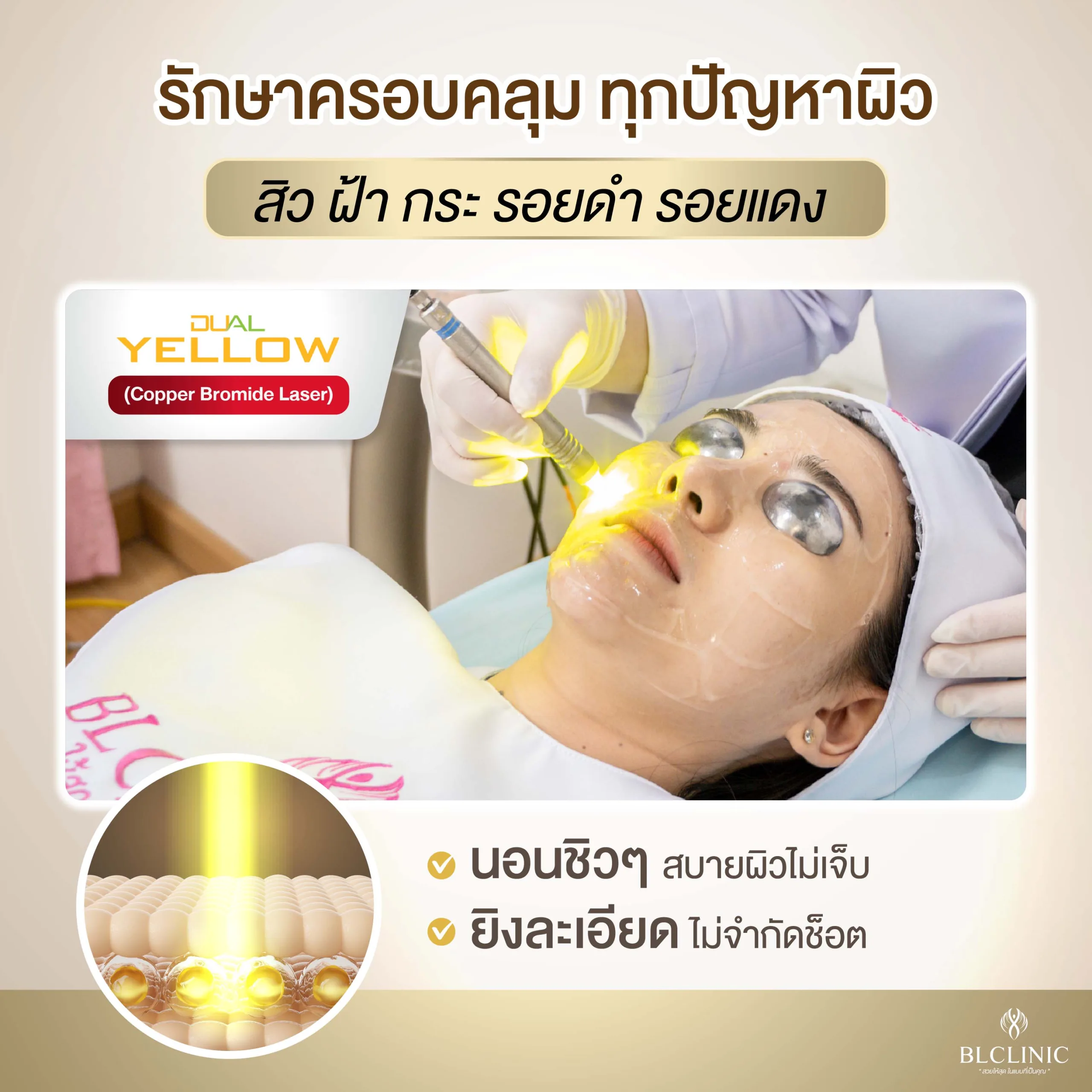 เลเซอร์หน้าใส Dual Yellow Laser แก้ปัญหาผิว สิว รอยแดง แบบจัดเต็ม