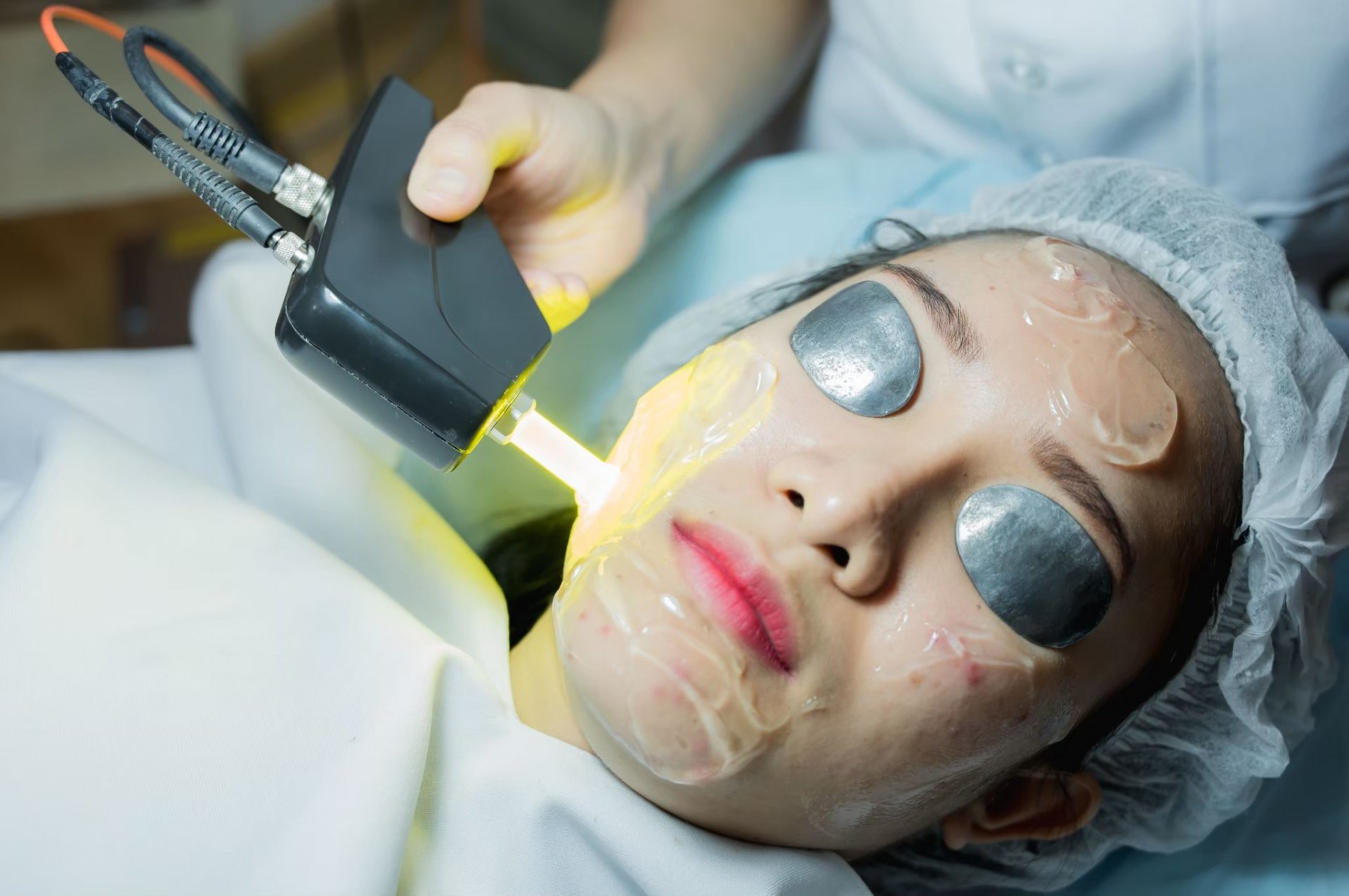 เลเซอร์หน้าใส Dual Yellow Laser แก้ปัญหาผิว สิว รอยแดง แบบจัดเต็ม