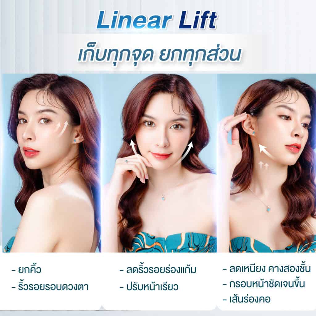 Linear-lift เทคโนโลยียกกระชับ Premium ฮิตสุดจากเกาหลี BL CLINIC ศูนย์ ...