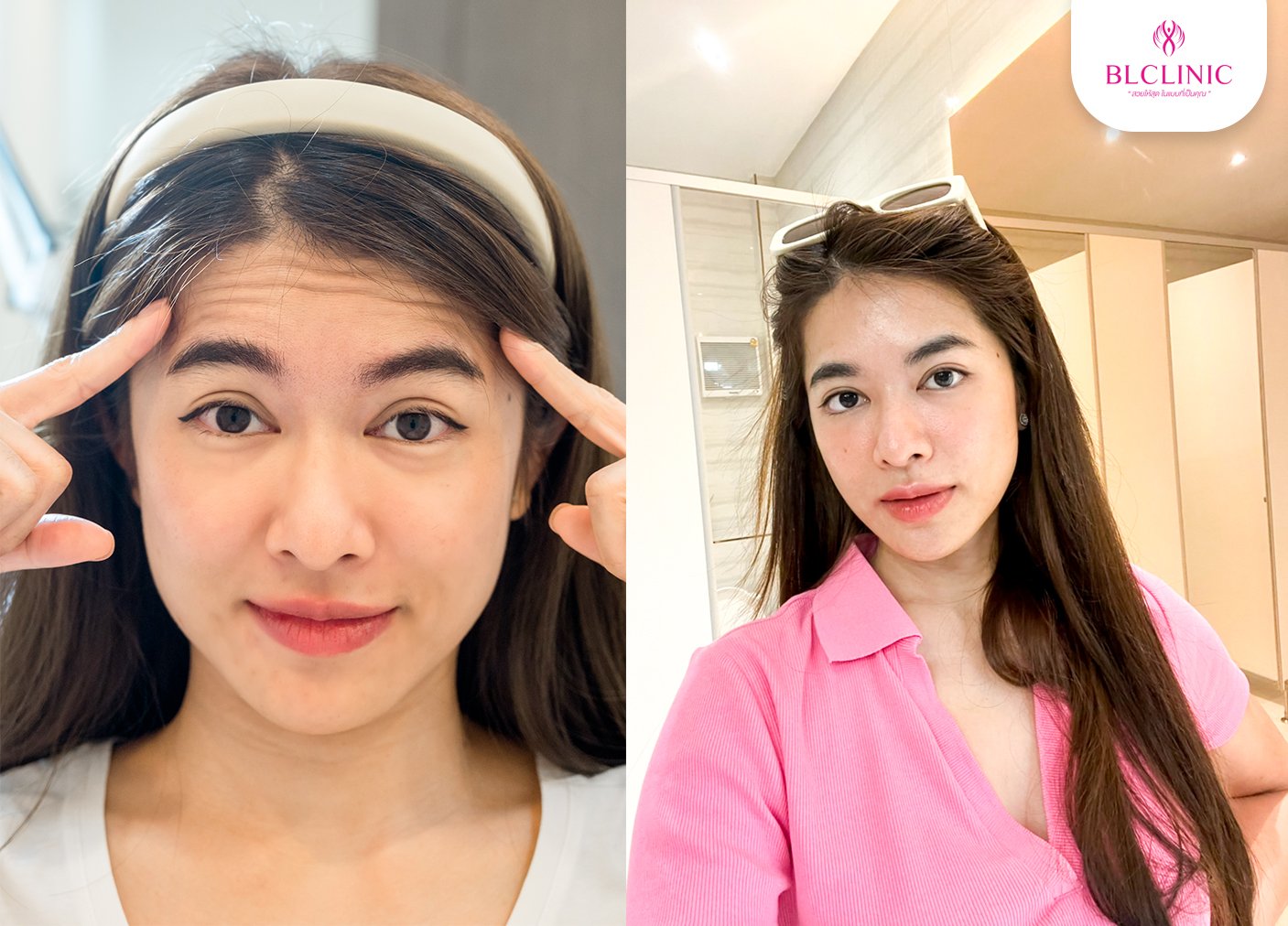 review-botox - BL CLINIC ศูนย์ความงามครบวงจรมาตรฐานระดับโลก