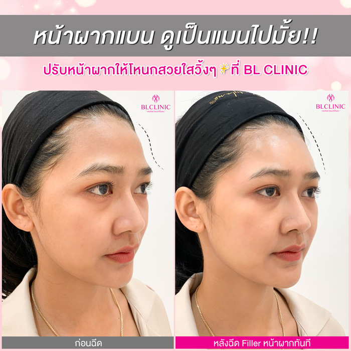 review-filler - BL CLINIC ศูนย์ความงามครบวงจรมาตรฐานระดับโลก